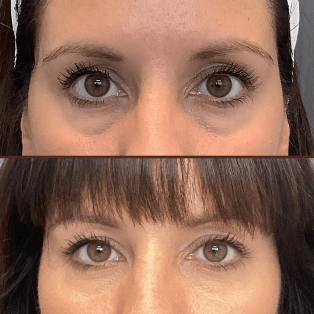 Patient 162901445 | Tear Trough Filler Before & After Photos | Elevé