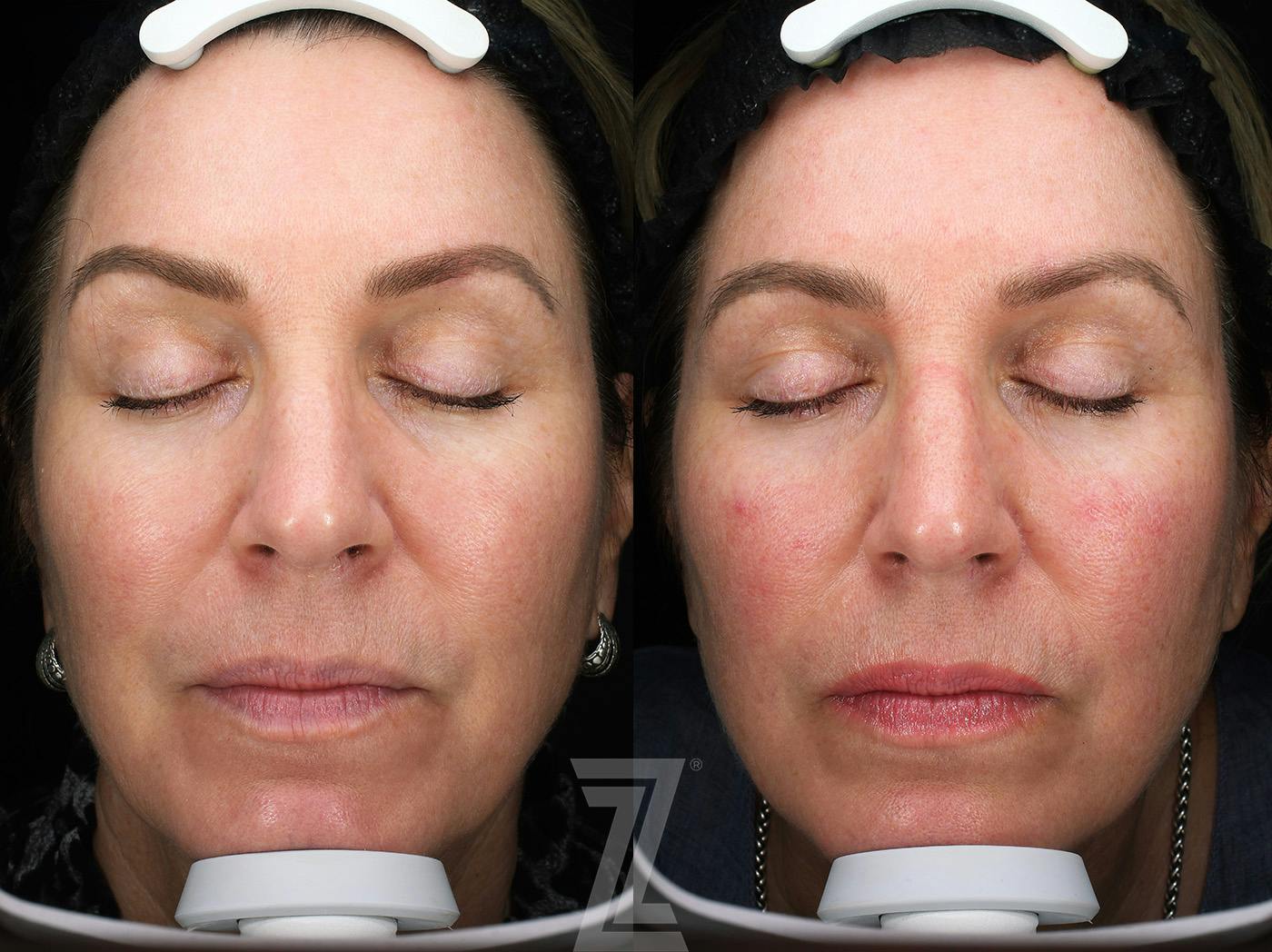 Patient 381677 | BBL Before & After Photos | The Piazza Center