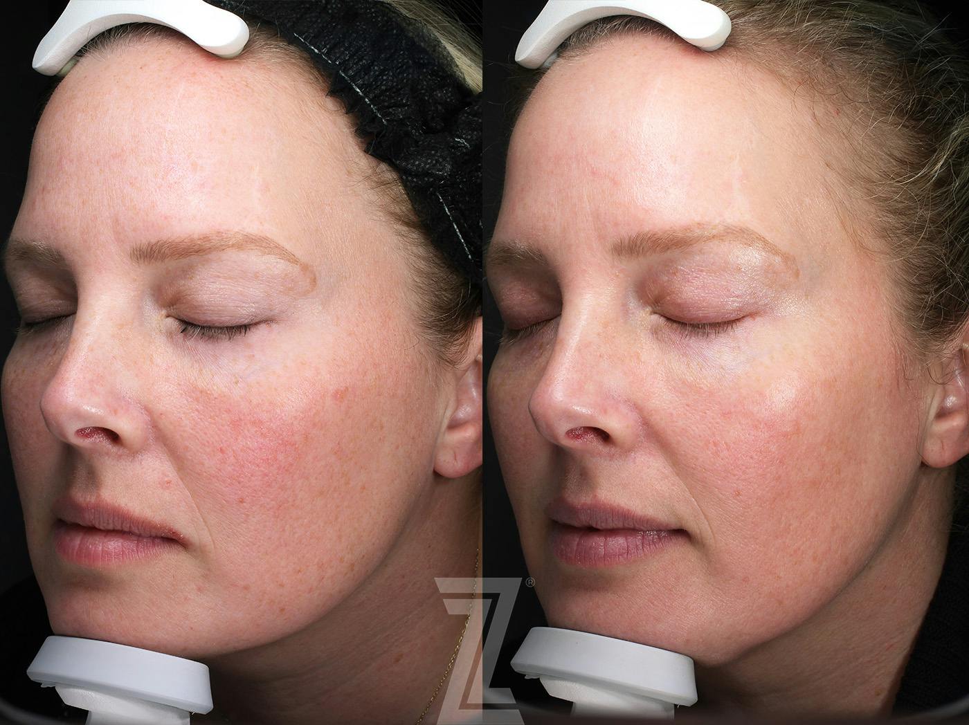 Patient 167983 | BBL Before & After Photos | The Piazza Center