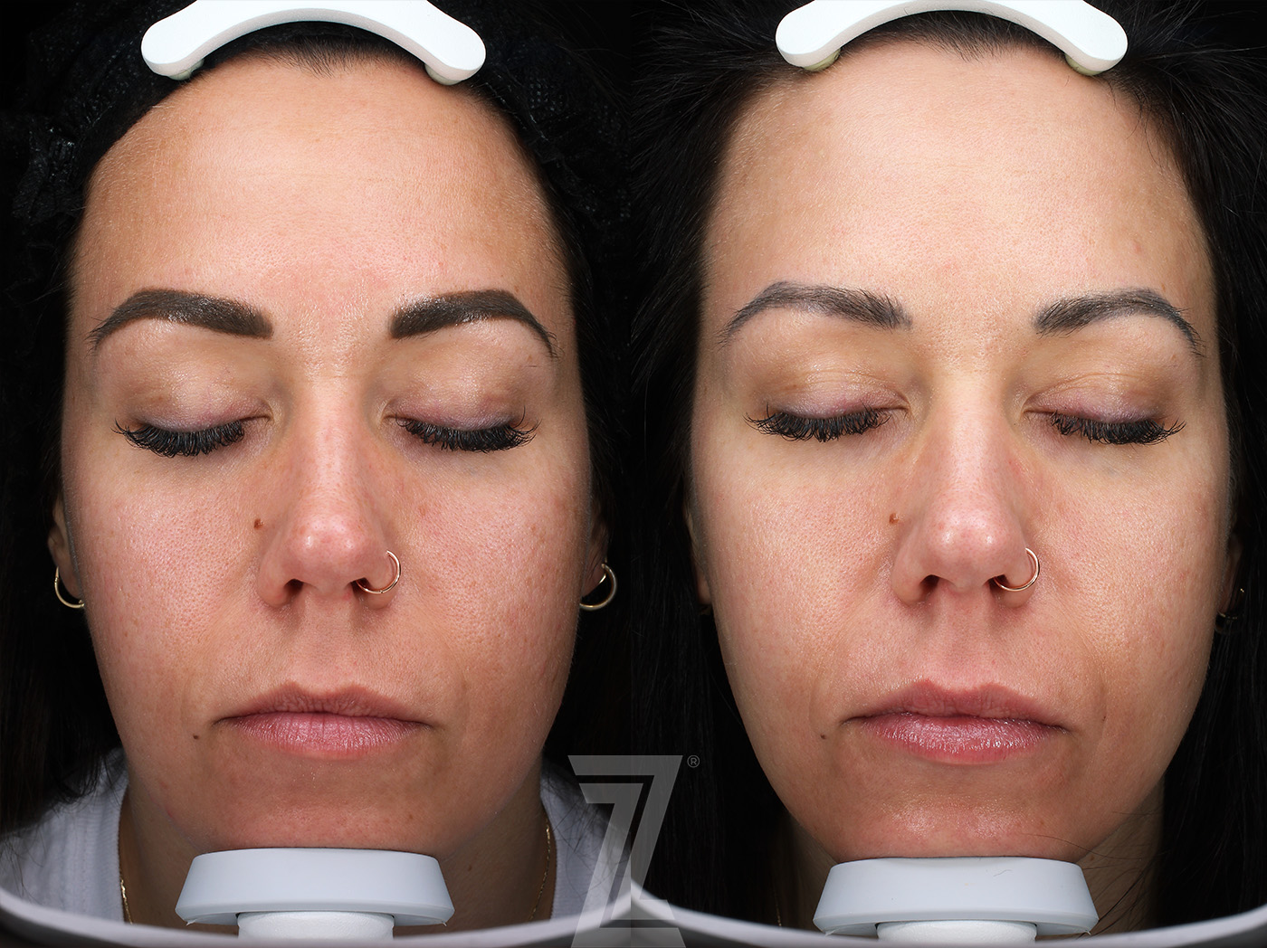 Patient 235330 | BBL Before & After Photos | The Piazza Center