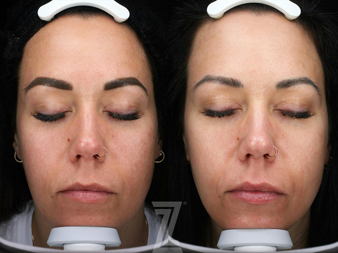 Patient 235330 | BBL Before & After Photos | The Piazza Center