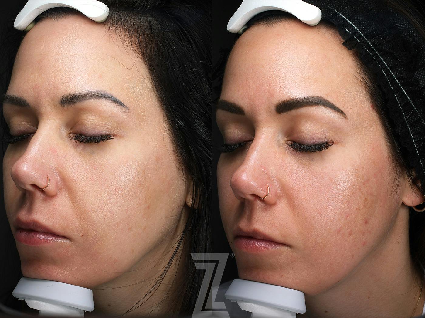 Patient 235330 | BBL Before & After Photos | The Piazza Center