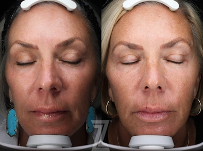 Profound® RF Microneedling Before & After Photos | The Piazza Center