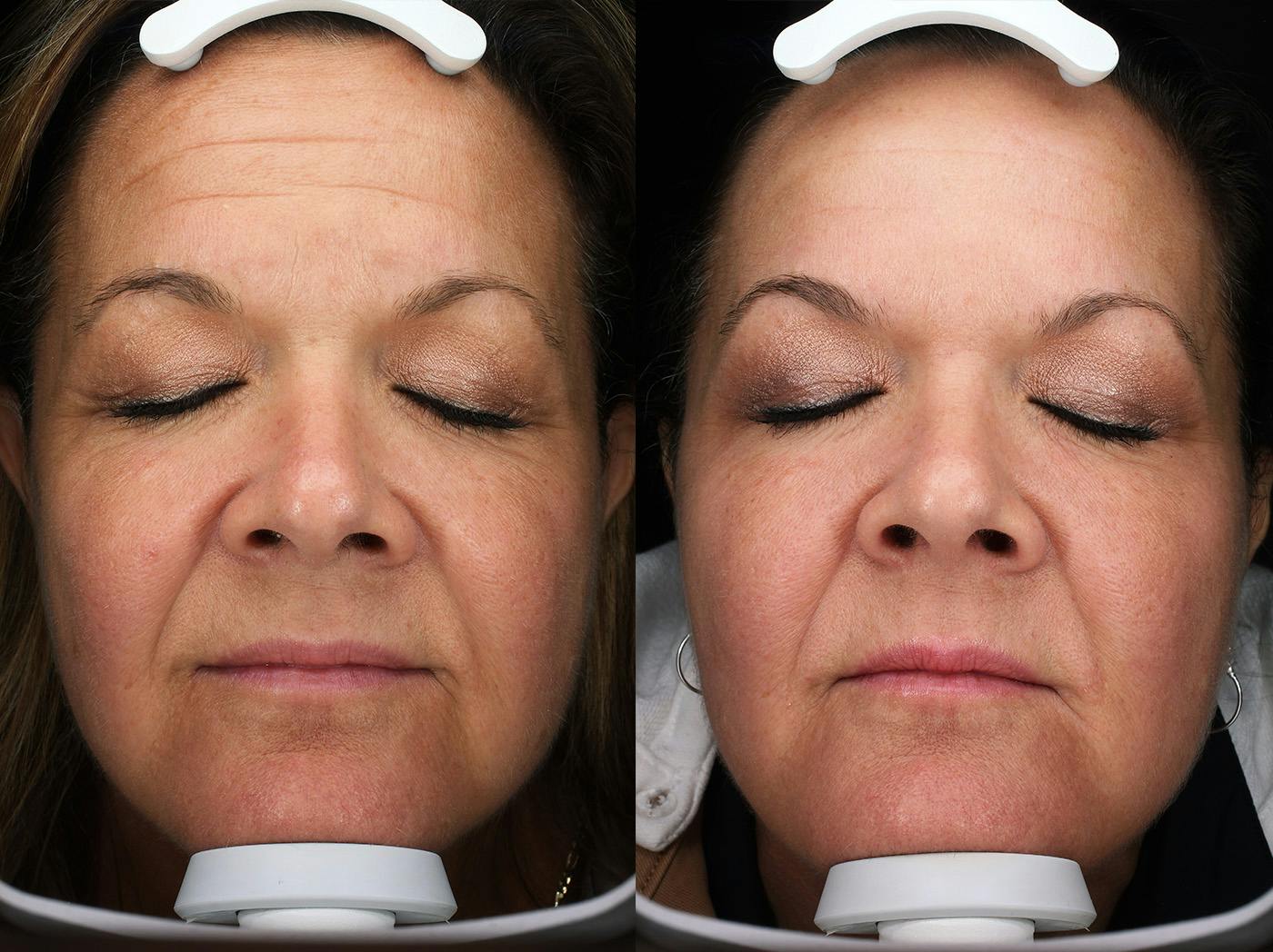 Patient 940109 | BBL Before & After Photos | The Piazza Center