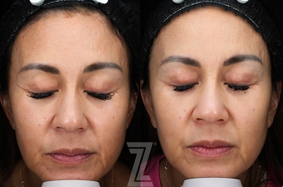 Profound® RF Microneedling Before & After Photos | The Piazza Center