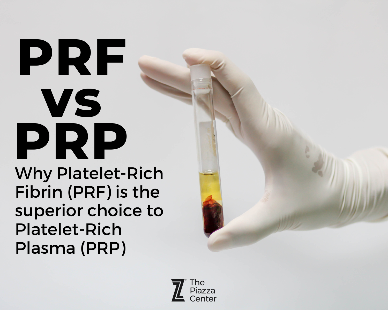 PRF vs PRP: Why Platelet-Rich Fibrin (PRF) is better than Platelet-Rich Plasma (PRP)