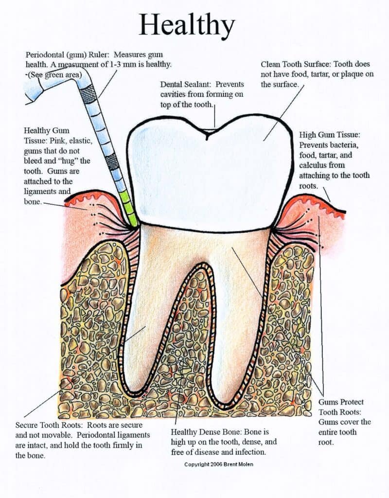 How To Recover from Gum Disease