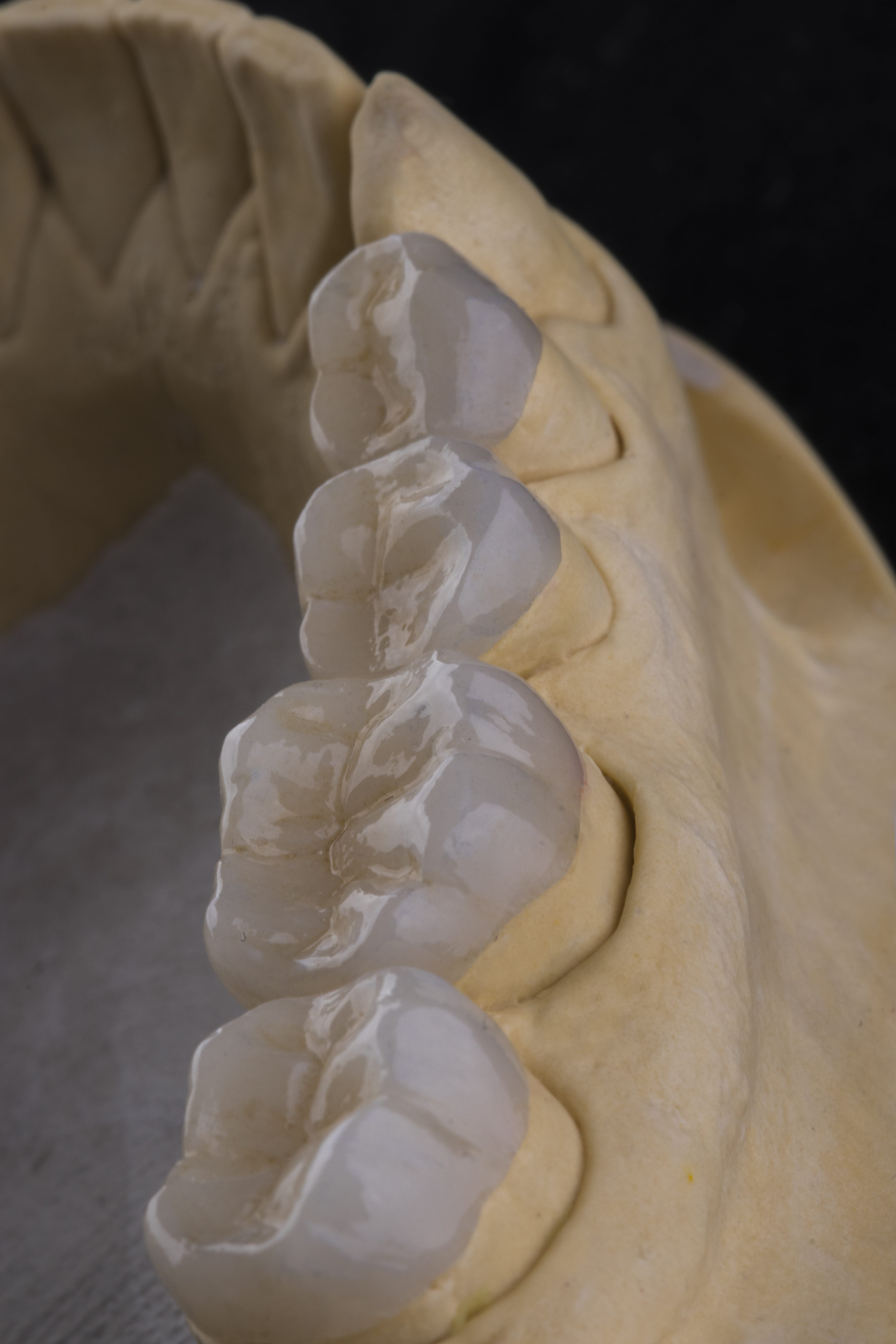 Custom-Designed Porcelain Fillings in Beverly Hills, Los Angeles