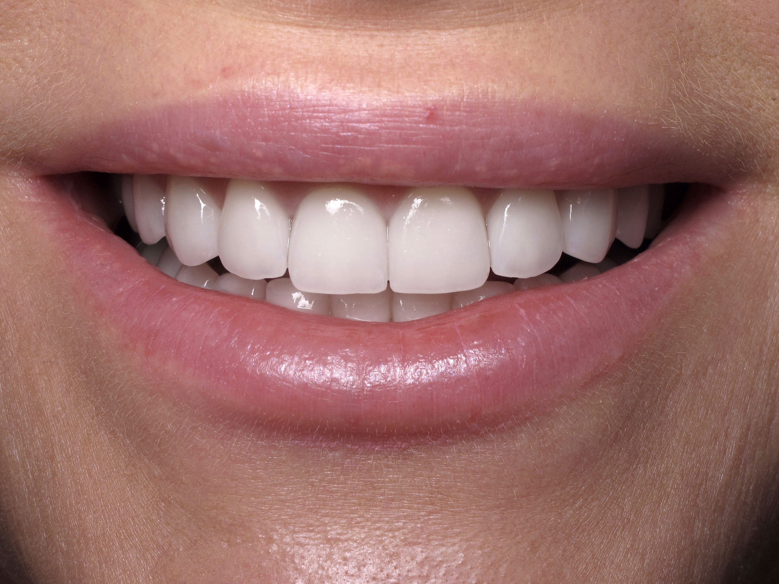 Upper Lip Lift Without Surgery in Los Angeles | Glosman LipLift Beverly ...