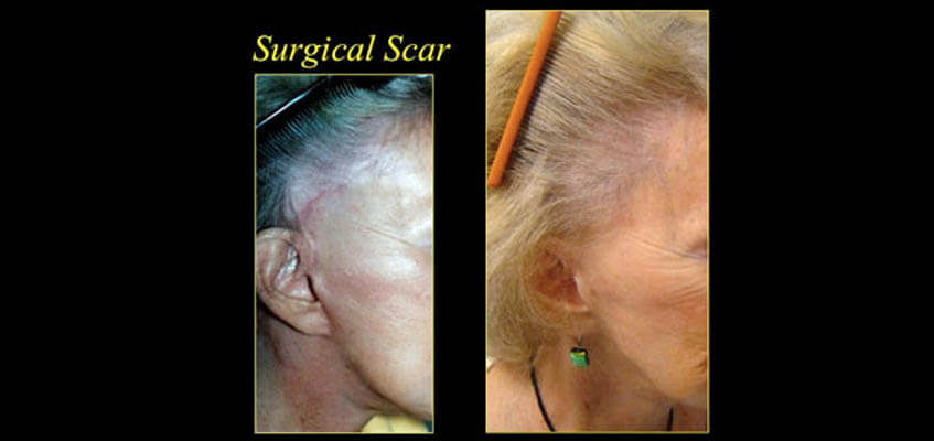 Facial Surgical Scars “Easily Treated and Removed” - Greco Hair Restoration