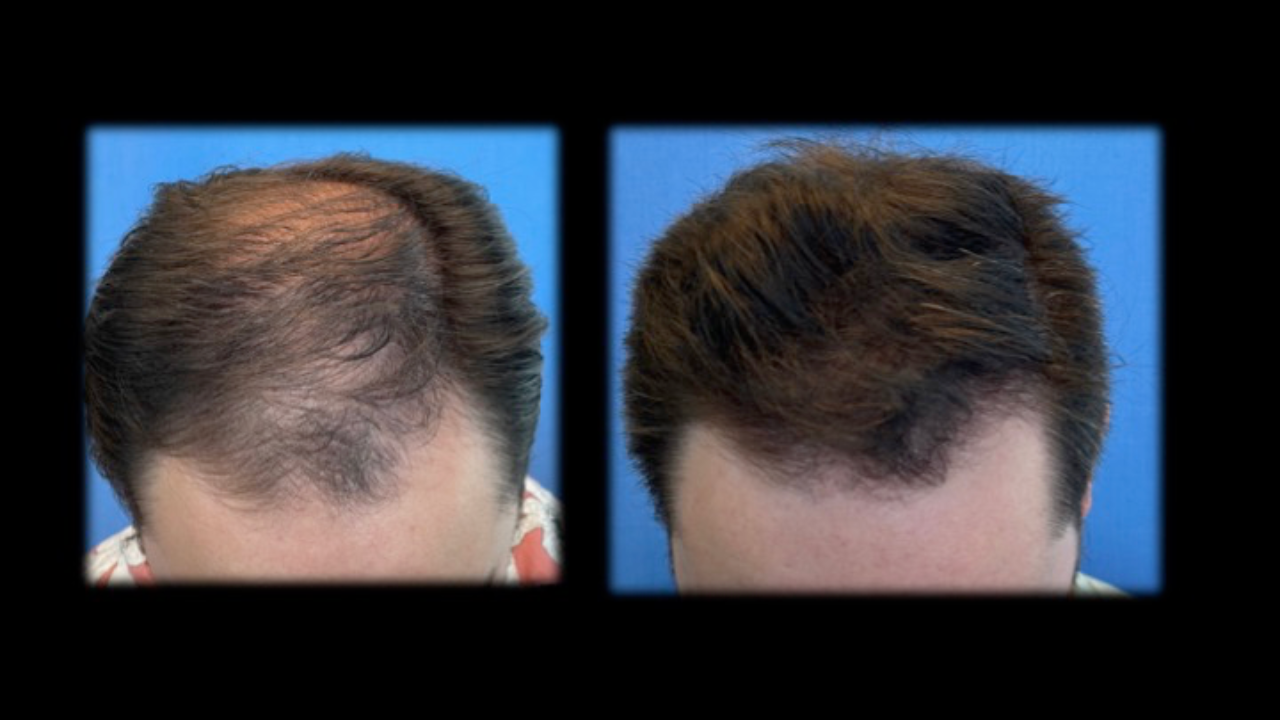 What is the “Combination Therapy” for Hair Restoration? | Blog | Greco ...