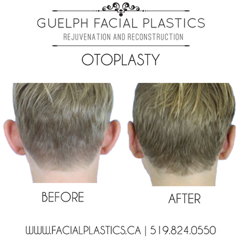 Otoplasty Explained | Ear Pinning Blog | Guelph Facial Plastics