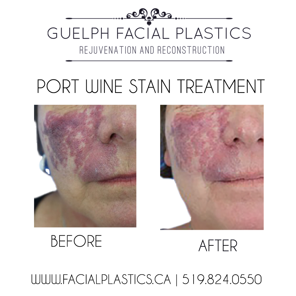 VBeam Perfecta for Port Wine Stains - Guelph Facial Plastics