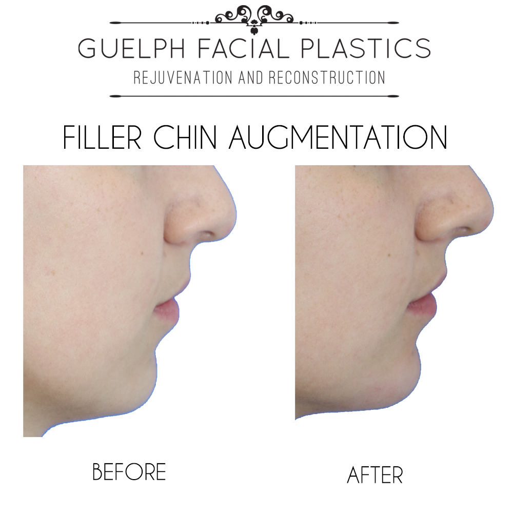 Non-Surgical Chin Augmentation with Fillers - Guelph Facial Plastics