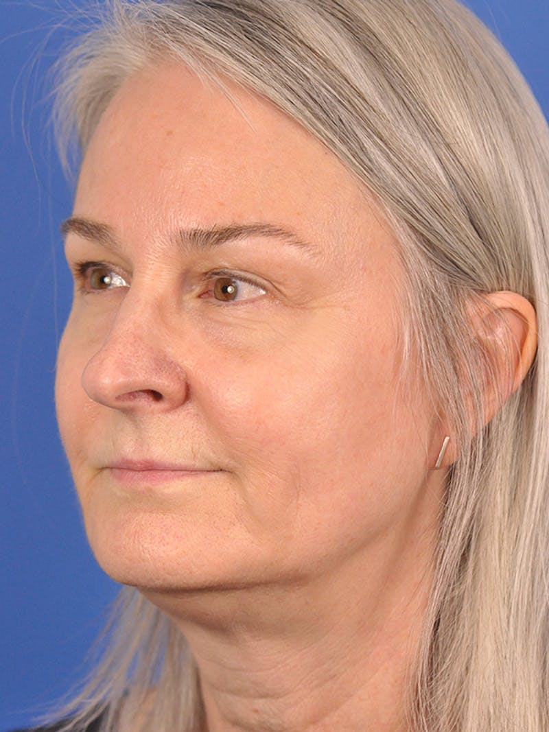 Patient 166375724 | CO2RE Laser Before & After Photos | Guelph Plastic ...