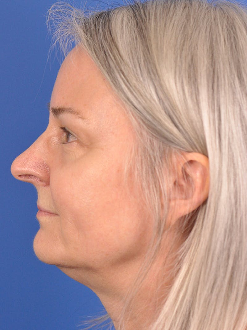 Patient 166375724 | CO2RE Laser Before & After Photos | Guelph Plastic ...