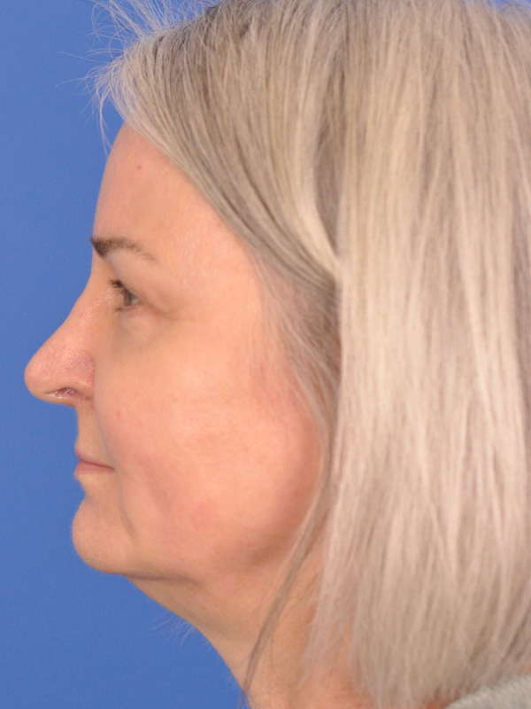 Patient 166375724 | CO2RE Laser Before & After Photos | Guelph Plastic ...