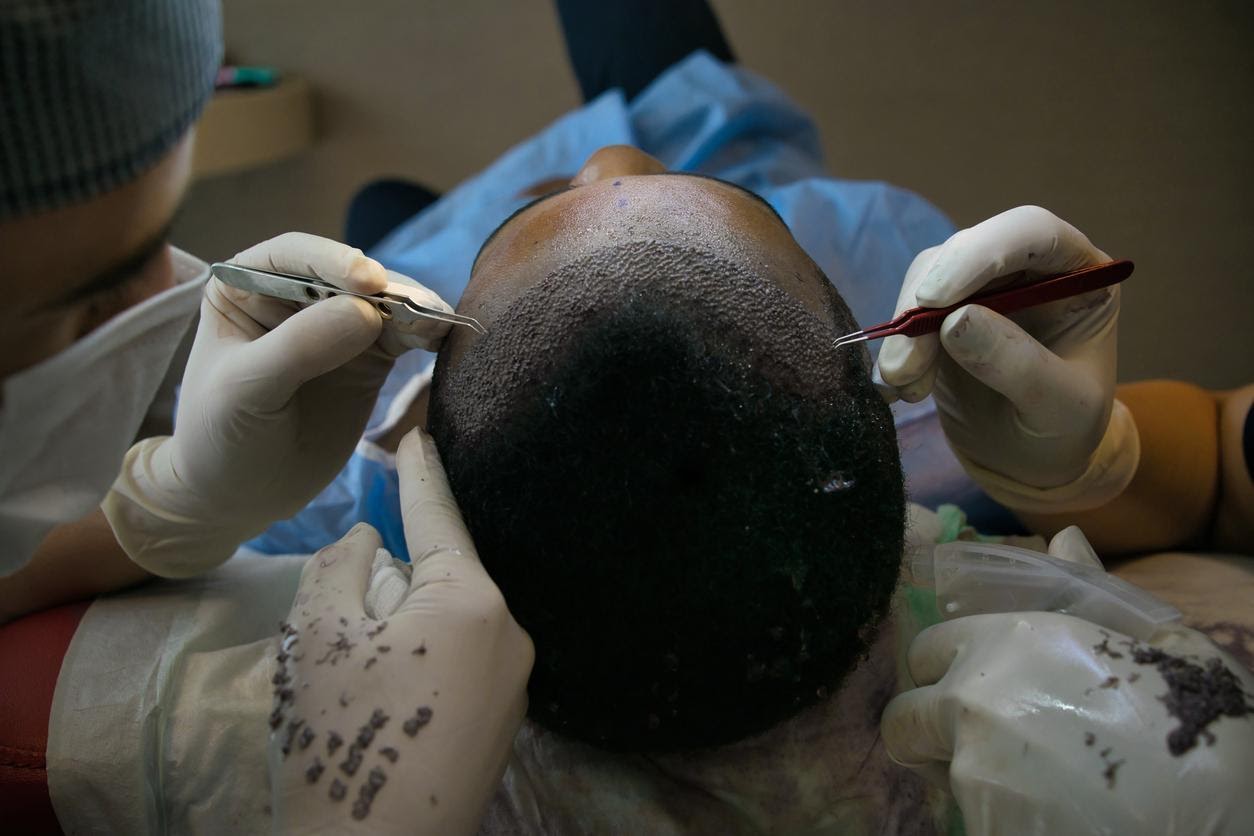 Everything You Need to Know About Getting a NeoGraft Hair Transplant ...