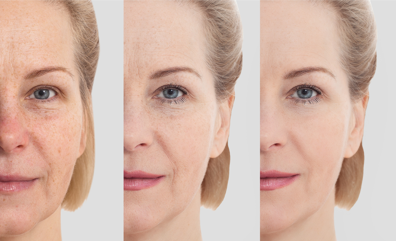 7 Ways to Get Rid of Wrinkles: A Step-By-Step Guide | Sarmela Sunder, MD 7 Ways to Get Rid of Wrinkles: A Step-By-Step Guide | Sarmela Sunder, MD