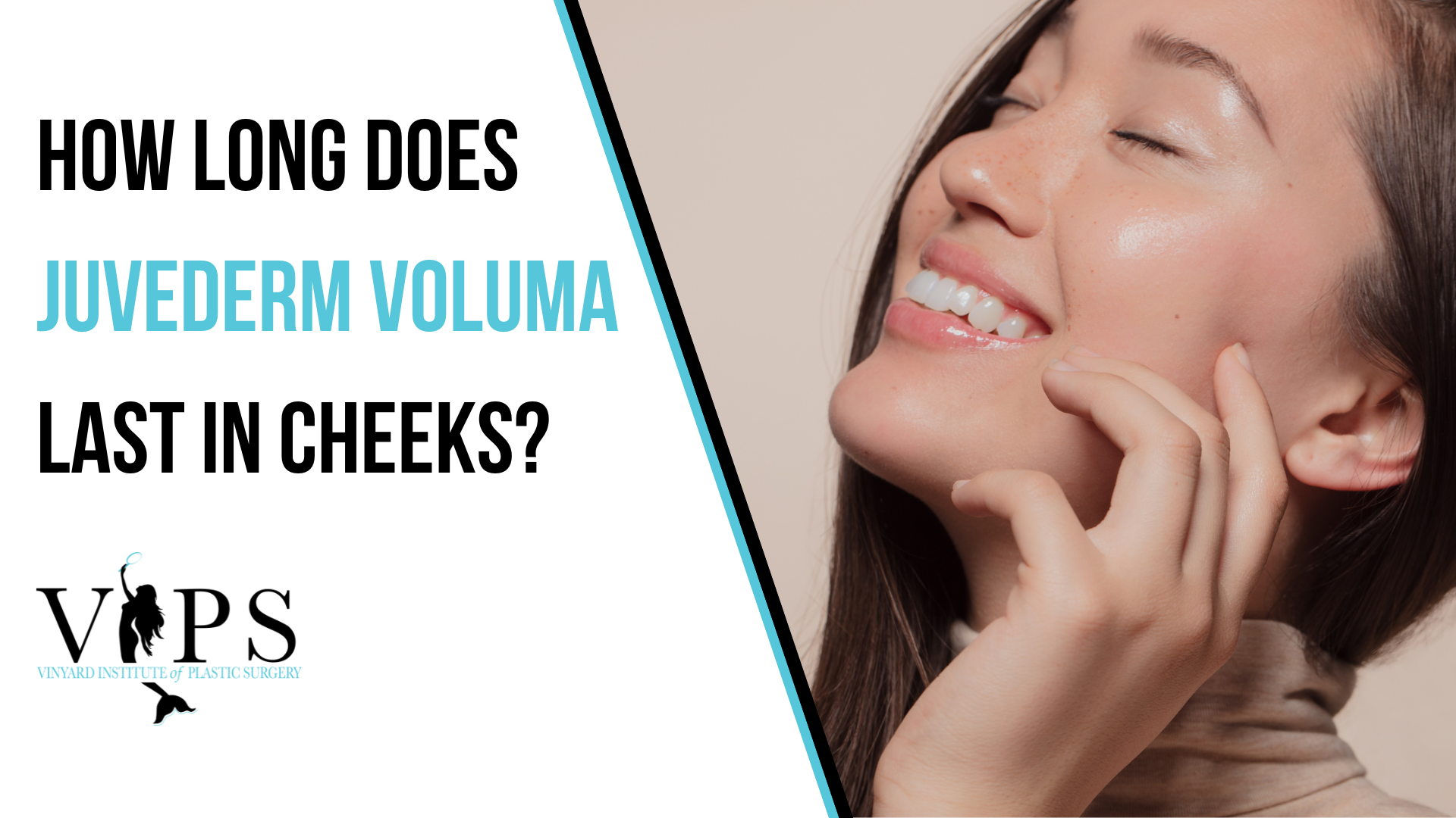 How Long Does Juvederm Voluma Last in Cheeks? How Long Does Juvederm Voluma Last in Cheeks?