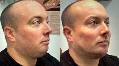 Liquid Chin & Jaw Contouring Before & After Photos | Goldfingers Aesthetics