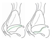Rhinoplasty Chicago, IL | Nose Job Expert | Dr. Anil Shah