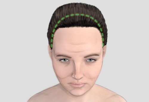 Brow Lift in Chicago, IL | Forehead Lift in Chicago with Dr. Anil Shah