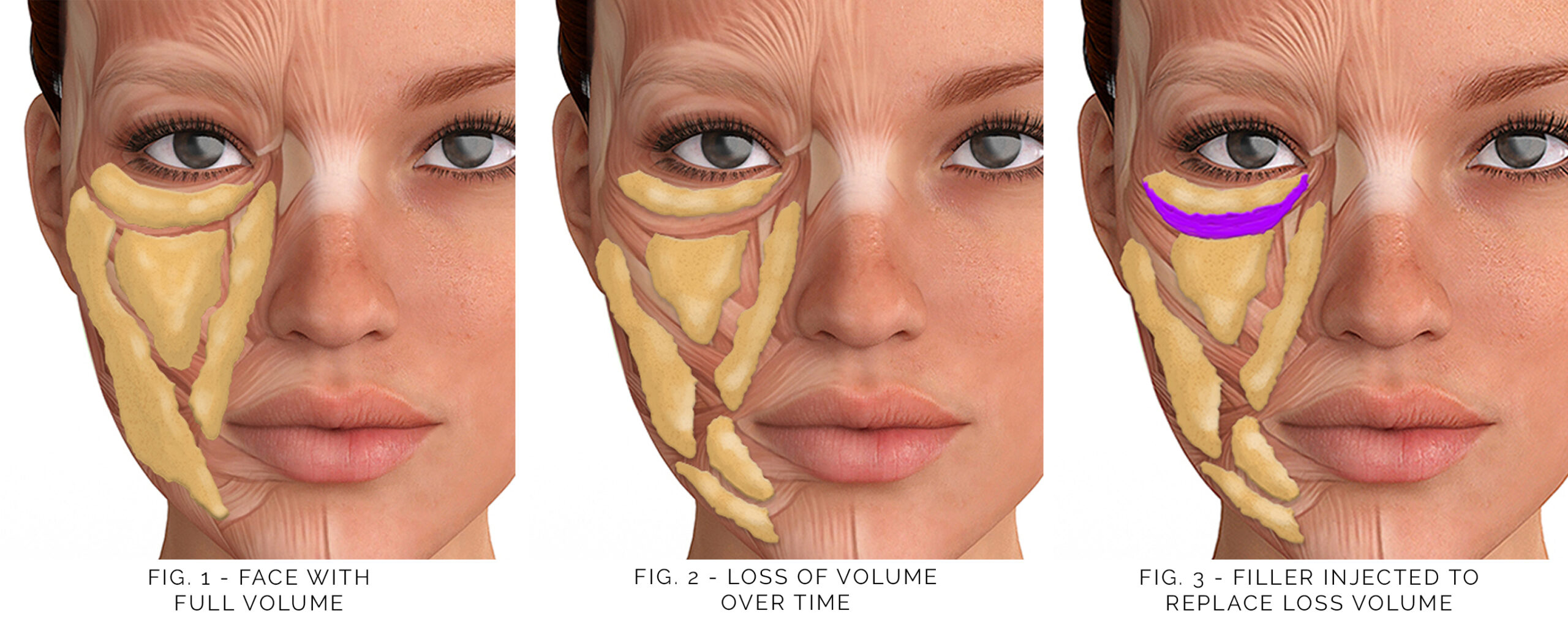 INFRAORBITAL HOLLOW | ANIL SHAH MD FACS | CHICAGO | BLOG