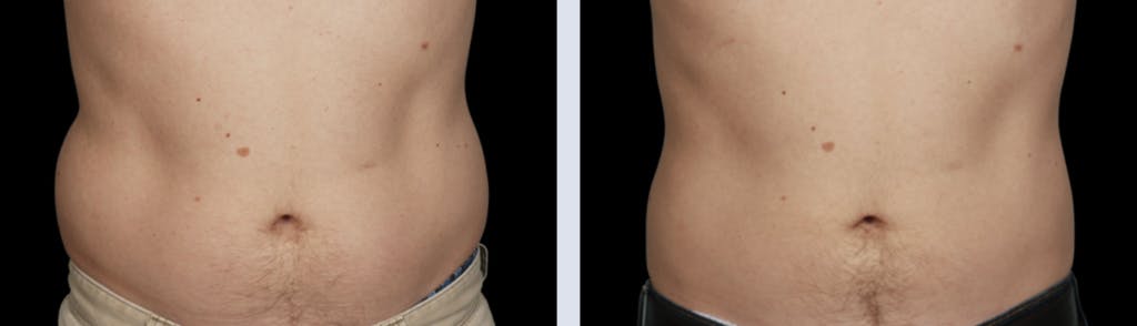 CoolSculpting vs Liposuction - Anil Shah MD FACS