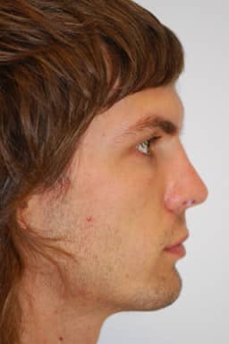 Male model rhinoplasty - Chicago, IL