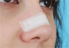How to Tape the Nose After Rhinoplasty | Dr. Shah