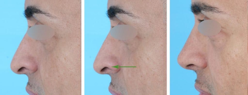 Alar Rim Grafts | Nasal Surgery Grafts
