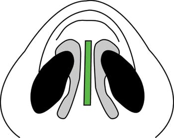 Columellar Struts | Chicago Rhinoplasty Grafts