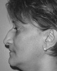 Radix Grafts | Dr. Anil Shah