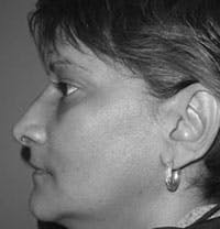 Radix Grafts | Dr. Anil Shah