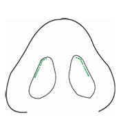 Rhinoplasty Incisions | Dr. Anil Shah, MD, FACS