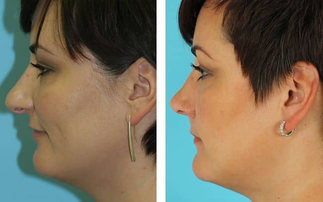 Treating the Bulbous Nasal Tip - Dr. Anil Shah, Chicago, IL