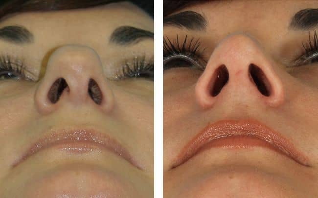 Treating the Bulbous Nasal Tip - Dr. Anil Shah, Chicago, IL
