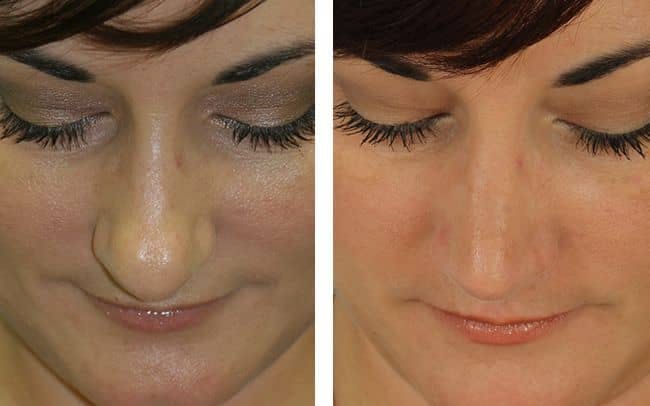 Treating the Bulbous Nasal Tip - Dr. Anil Shah, Chicago, IL