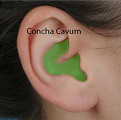 Prominent Conchal Bowl | Dr. Anil Shah