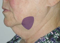 Jowls | Plastic Surgery Facial Procedures