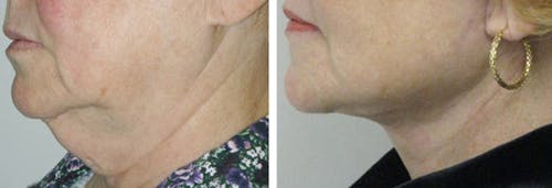 Jowls | Plastic Surgery Facial Procedures