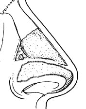 Alar Retraction Chicago | Dr Shah