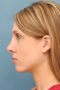 Alar Retraction Chicago | Dr Shah