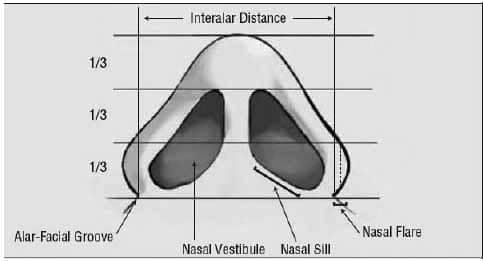 Alar Base Resection and Repair | Chicago Illinois