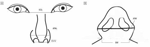 Alar Base Resection and Repair | Chicago Illinois