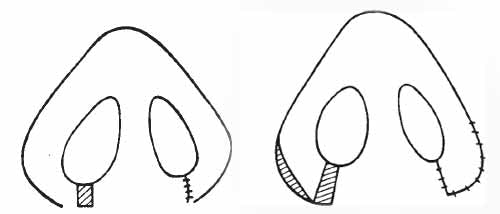 Alar Base Resection and Repair | Chicago Illinois