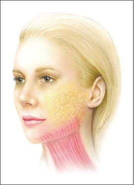 Defining the Facial extend of the Platysma Muscle | Article