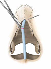 Crooked Nose Suture | Suture Suspension Technique