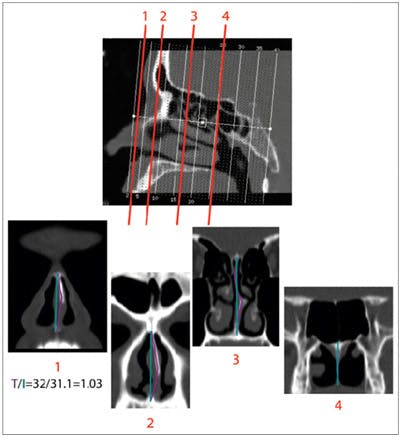 Nasal septal deviation in the pediatric and adult